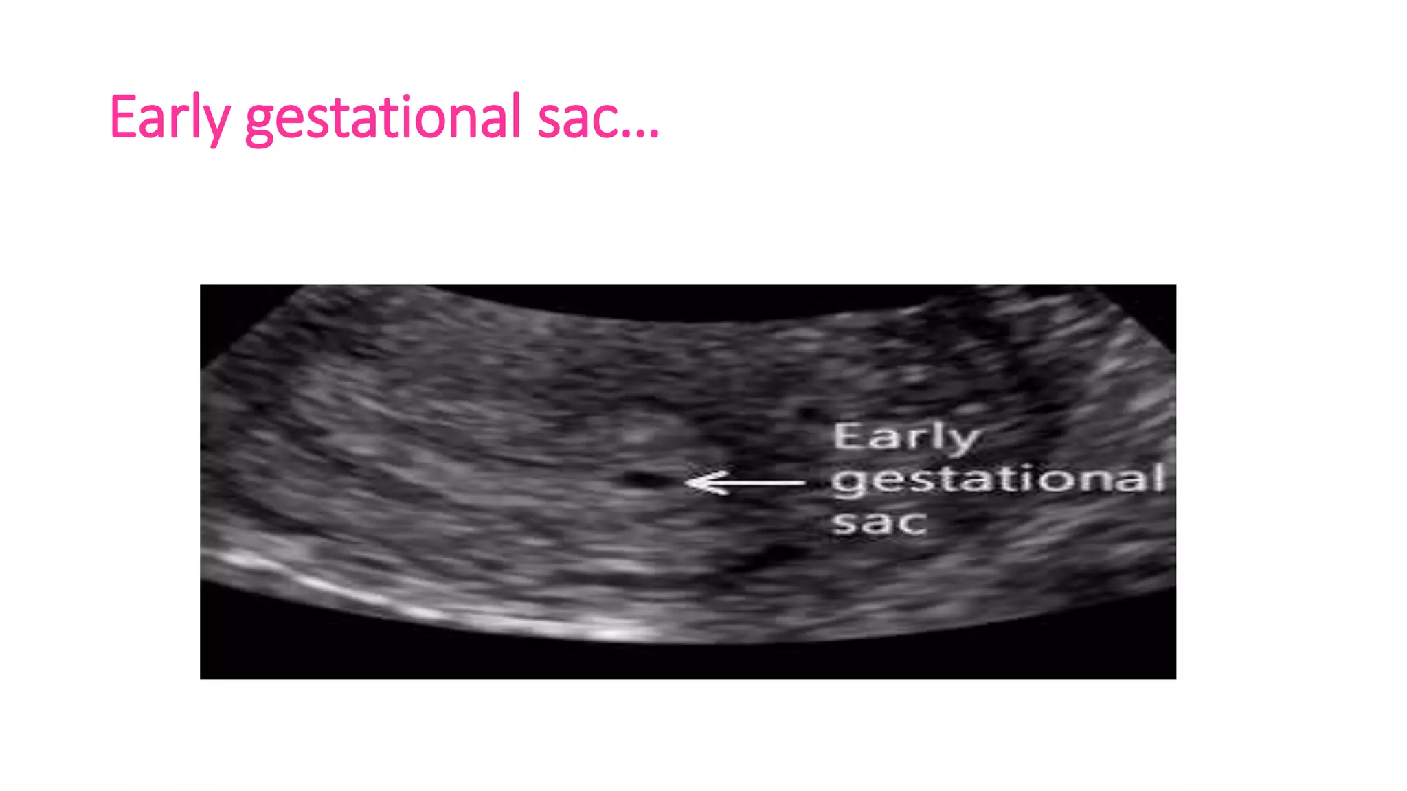 Ultrasound and usg doppler in obstetrics | PPTX