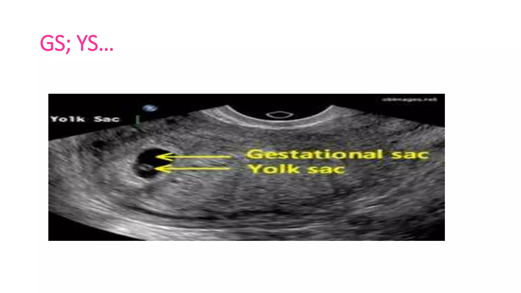 Ultrasound and usg doppler in obstetrics | PPTX
