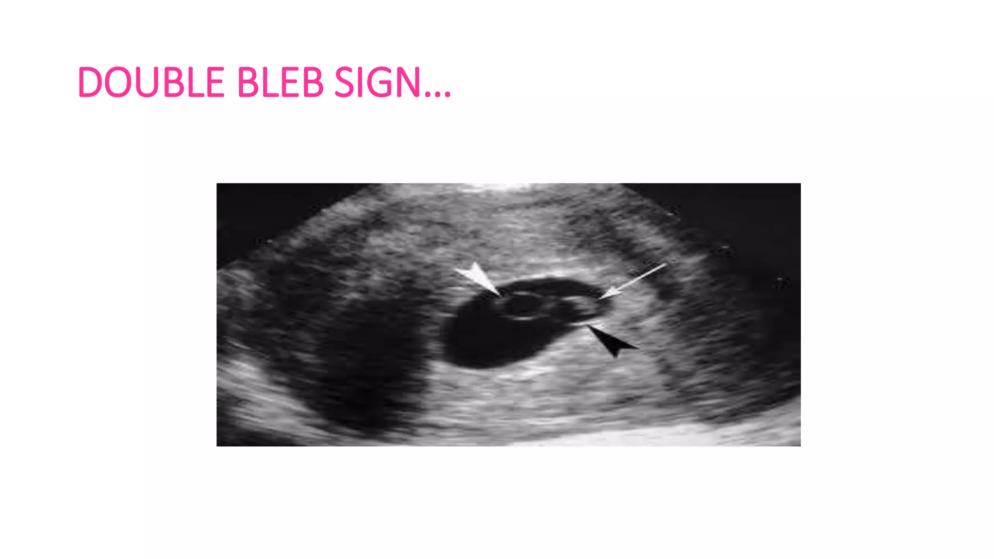 Ultrasound and usg doppler in obstetrics | PPTX