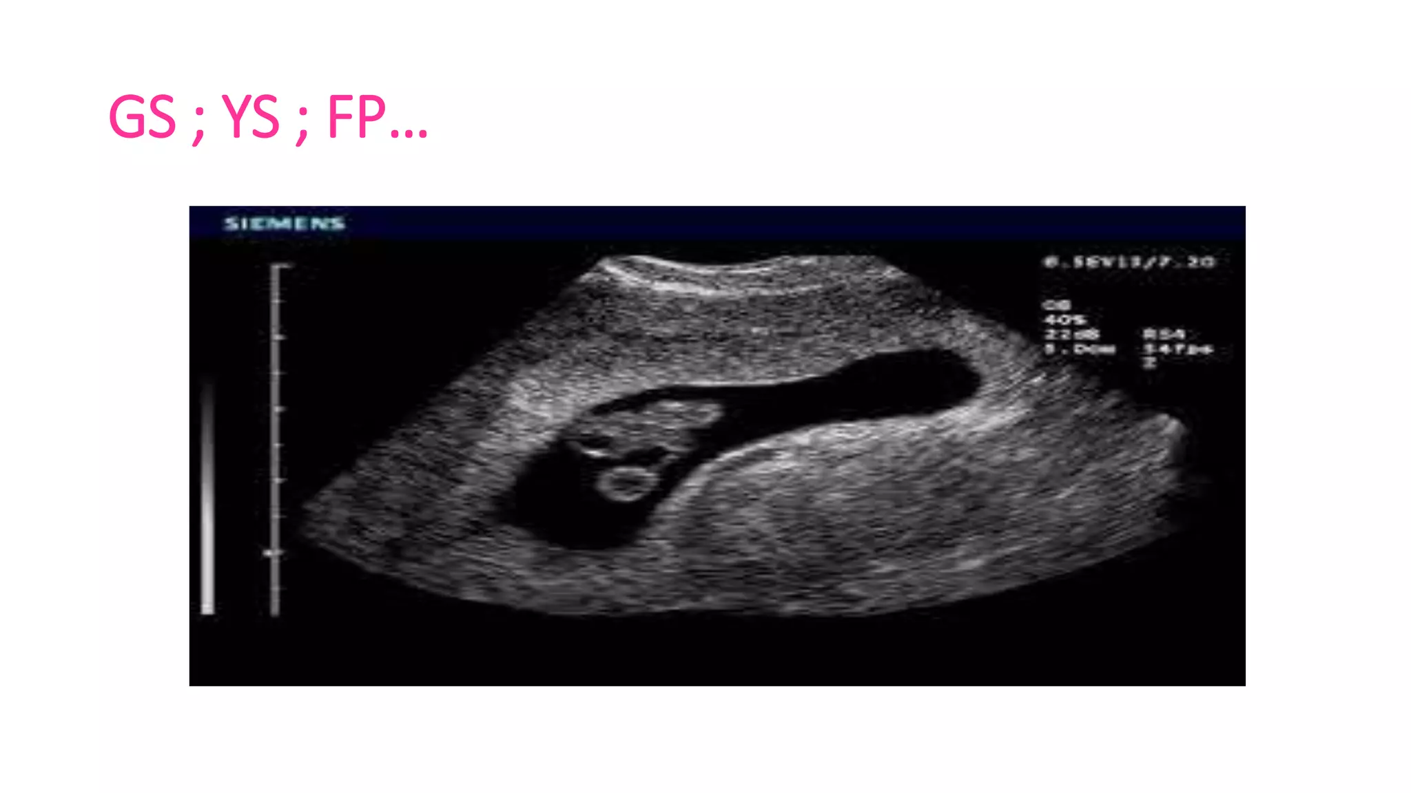 Ultrasound and usg doppler in obstetrics | PPTX