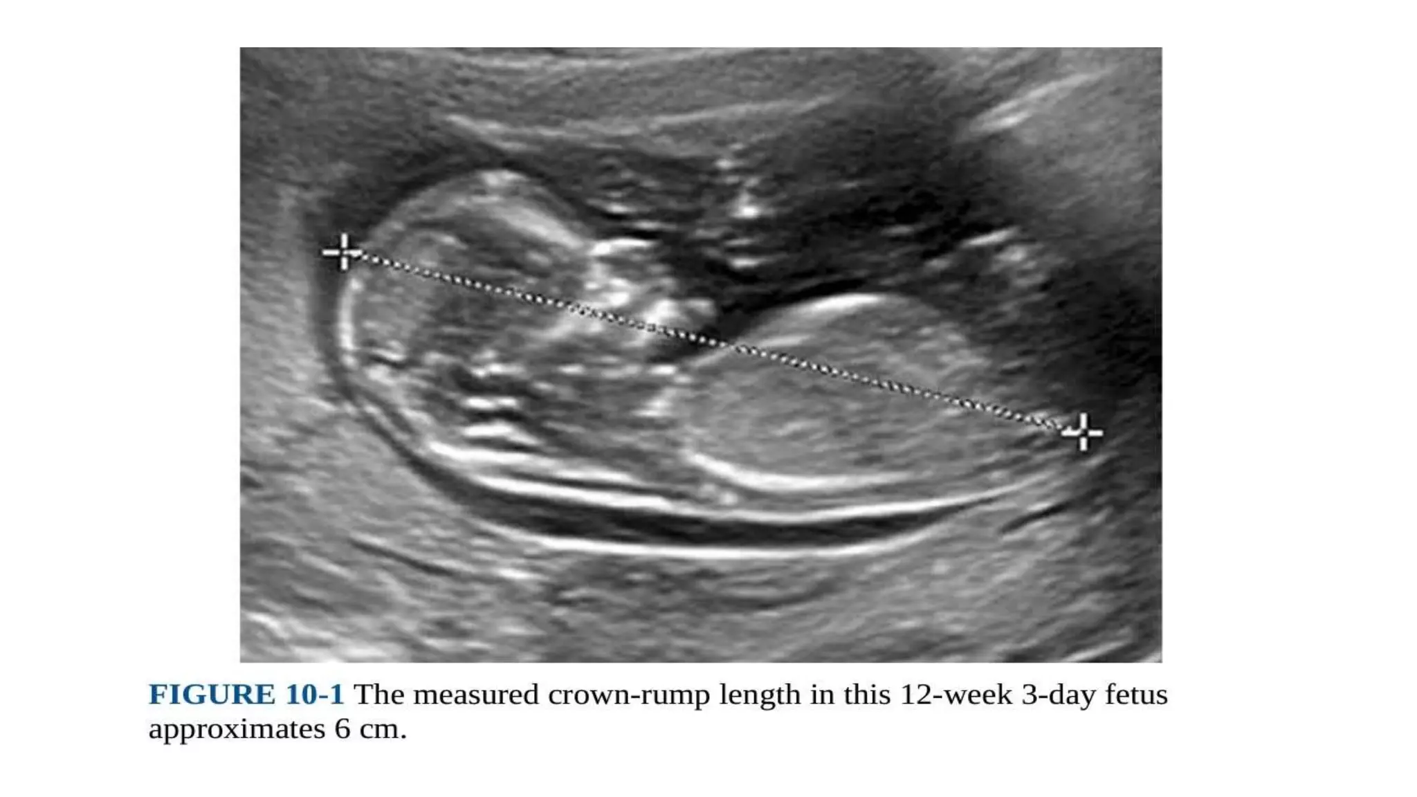 Ultrasound and usg doppler in obstetrics | PPTX