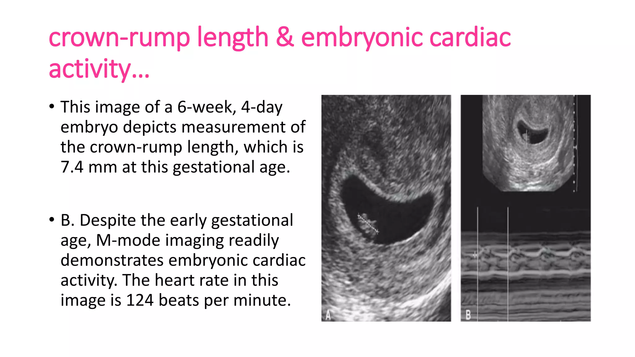 Ultrasound and usg doppler in obstetrics | PPTX