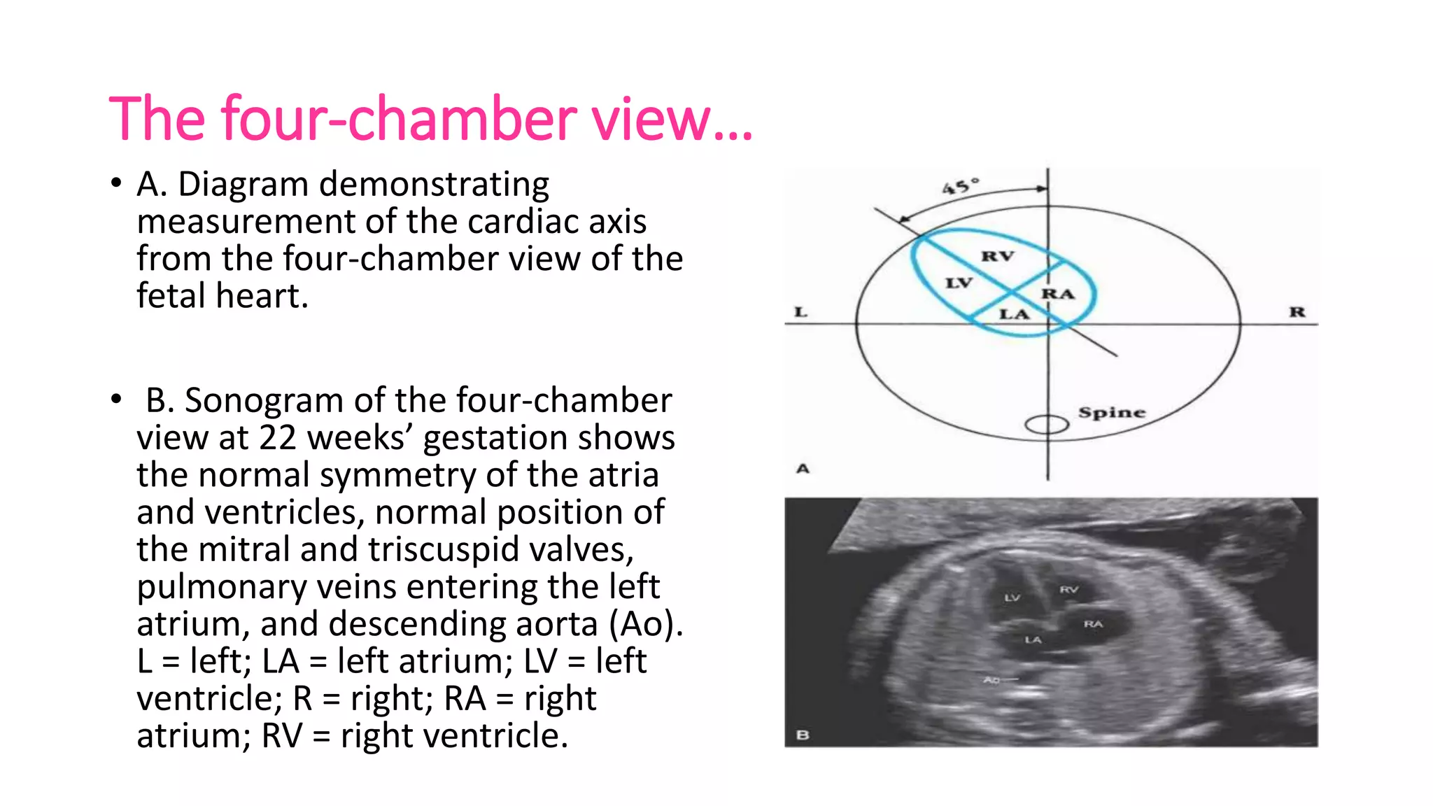 Ultrasound and usg doppler in obstetrics | PPTX