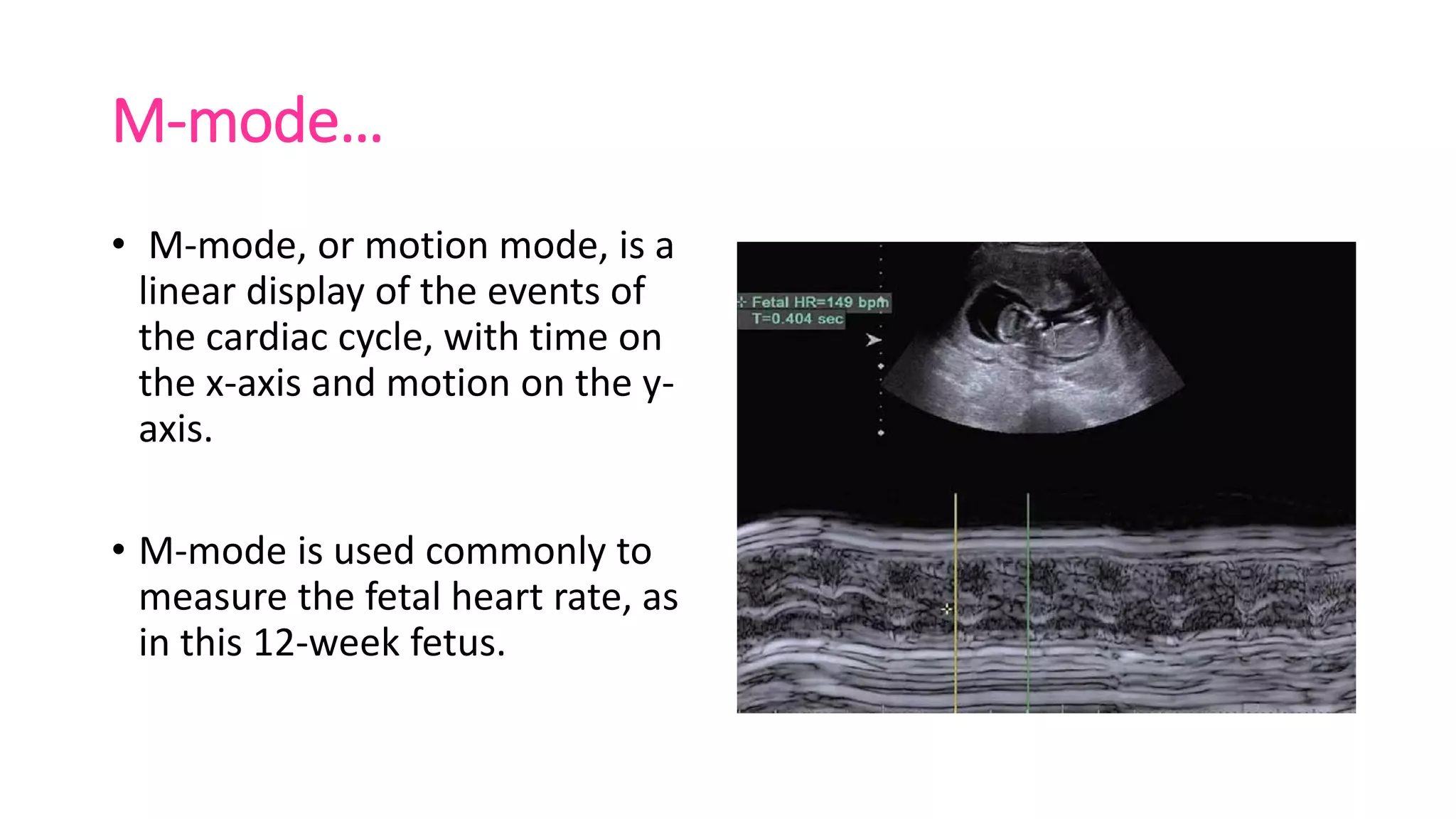 Ultrasound and usg doppler in obstetrics | PPTX