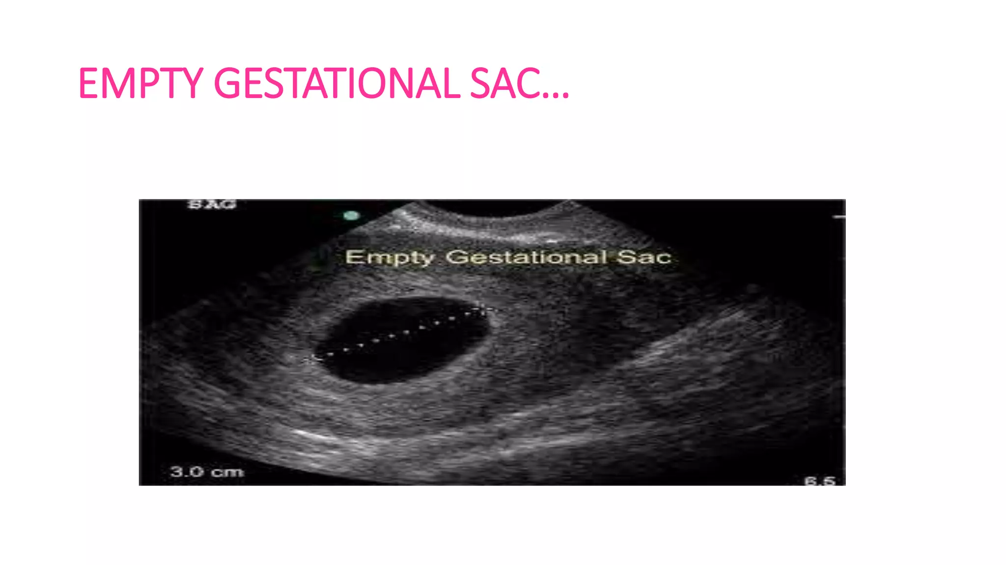 Ultrasound and usg doppler in obstetrics | PPTX