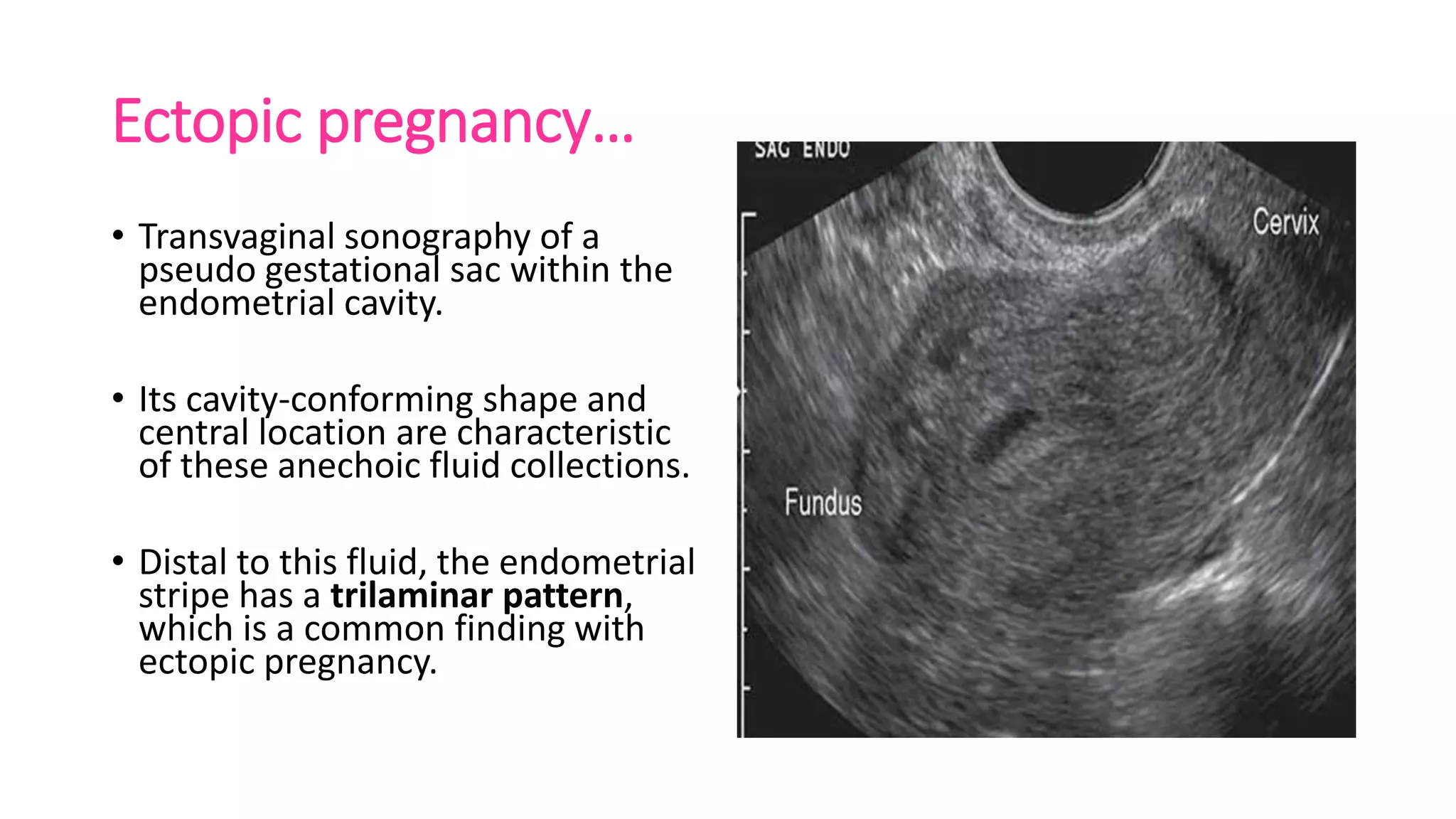 Ultrasound and usg doppler in obstetrics | PPTX
