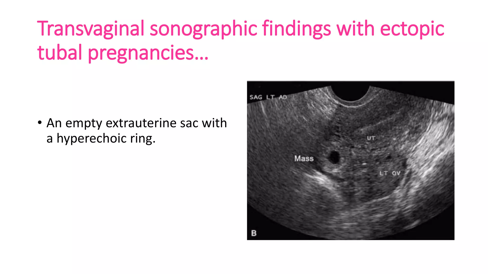 Ultrasound and usg doppler in obstetrics | PPTX