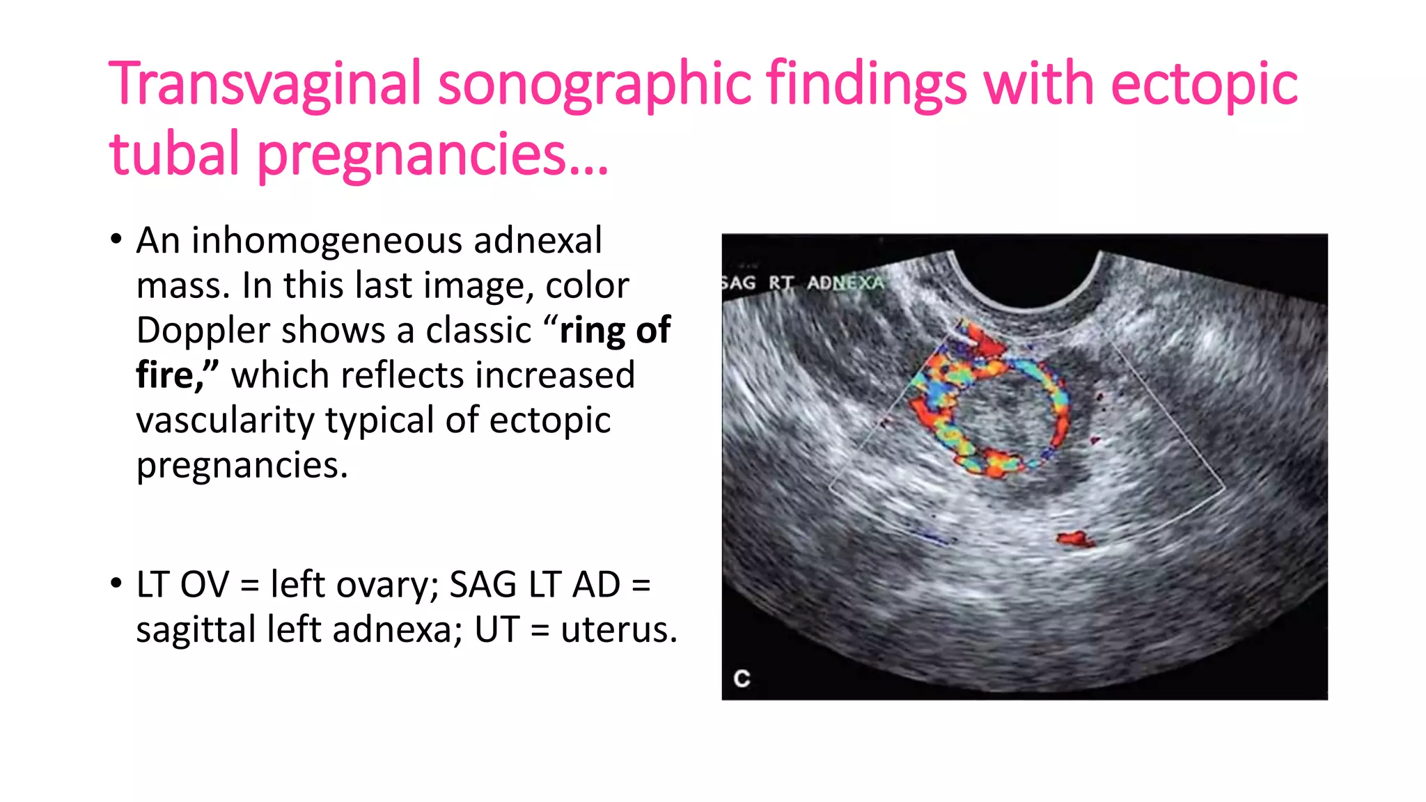 Ultrasound and usg doppler in obstetrics | PPTX