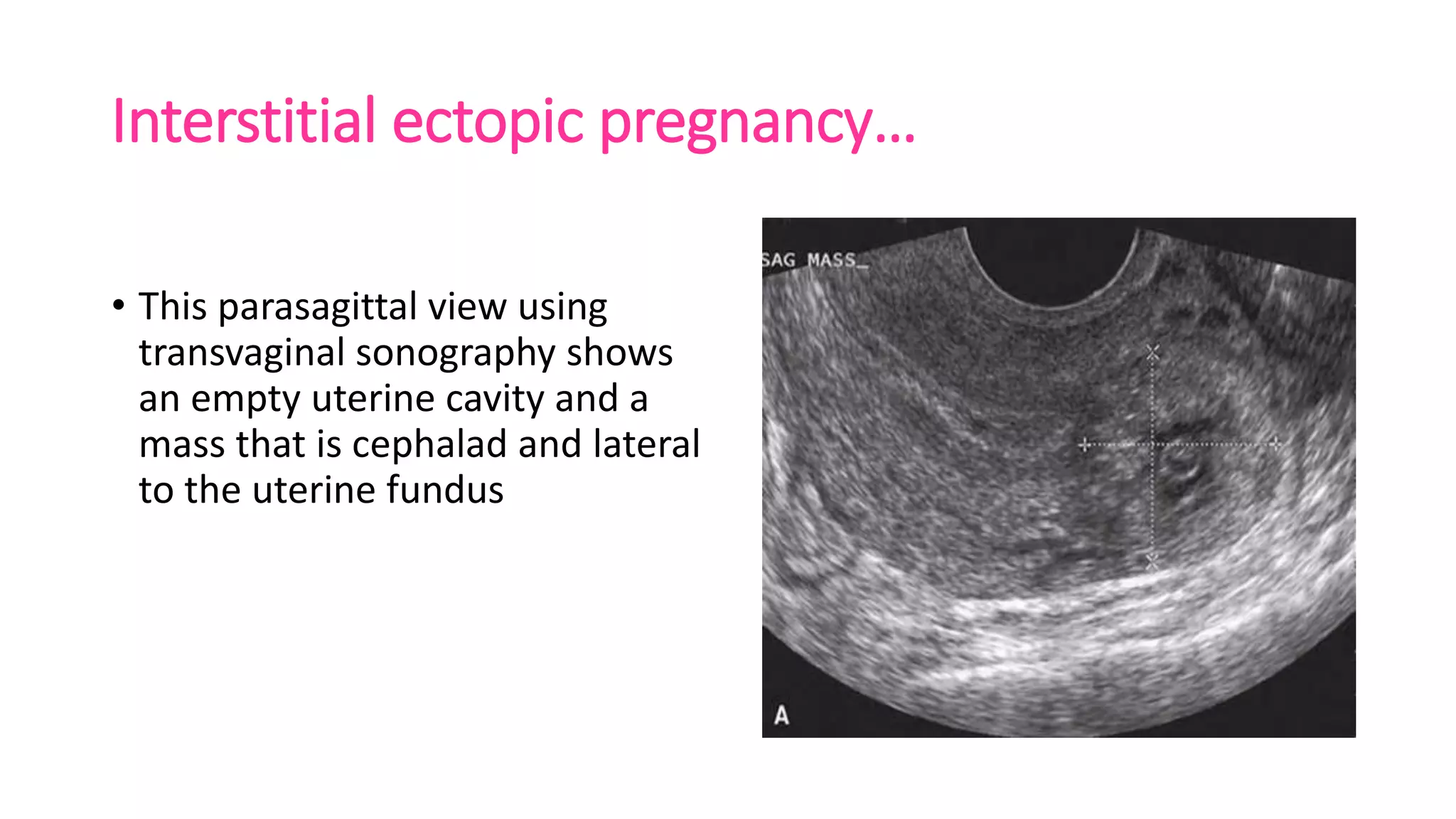 Ultrasound and usg doppler in obstetrics | PPTX
