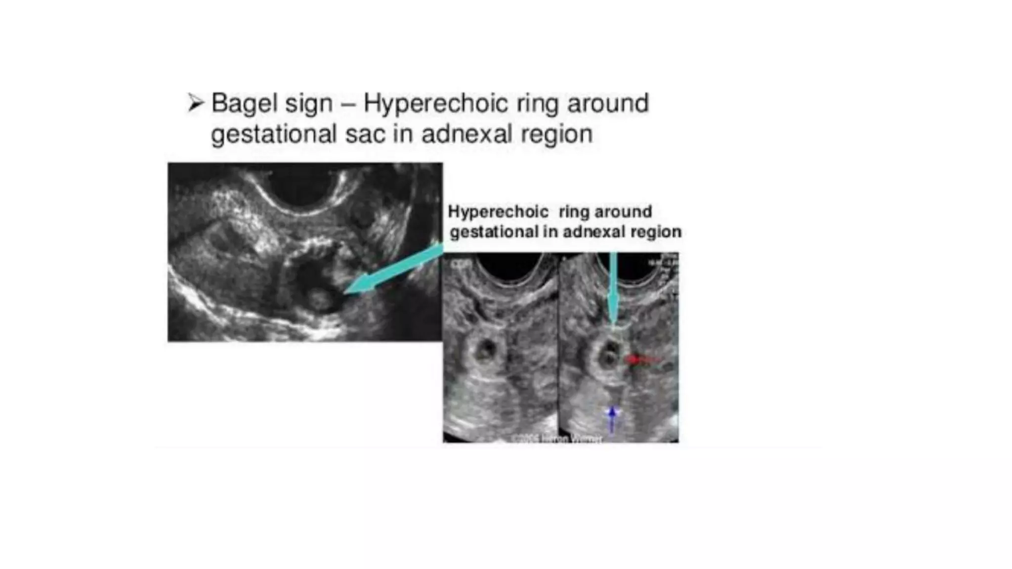 Ultrasound and usg doppler in obstetrics | PPTX