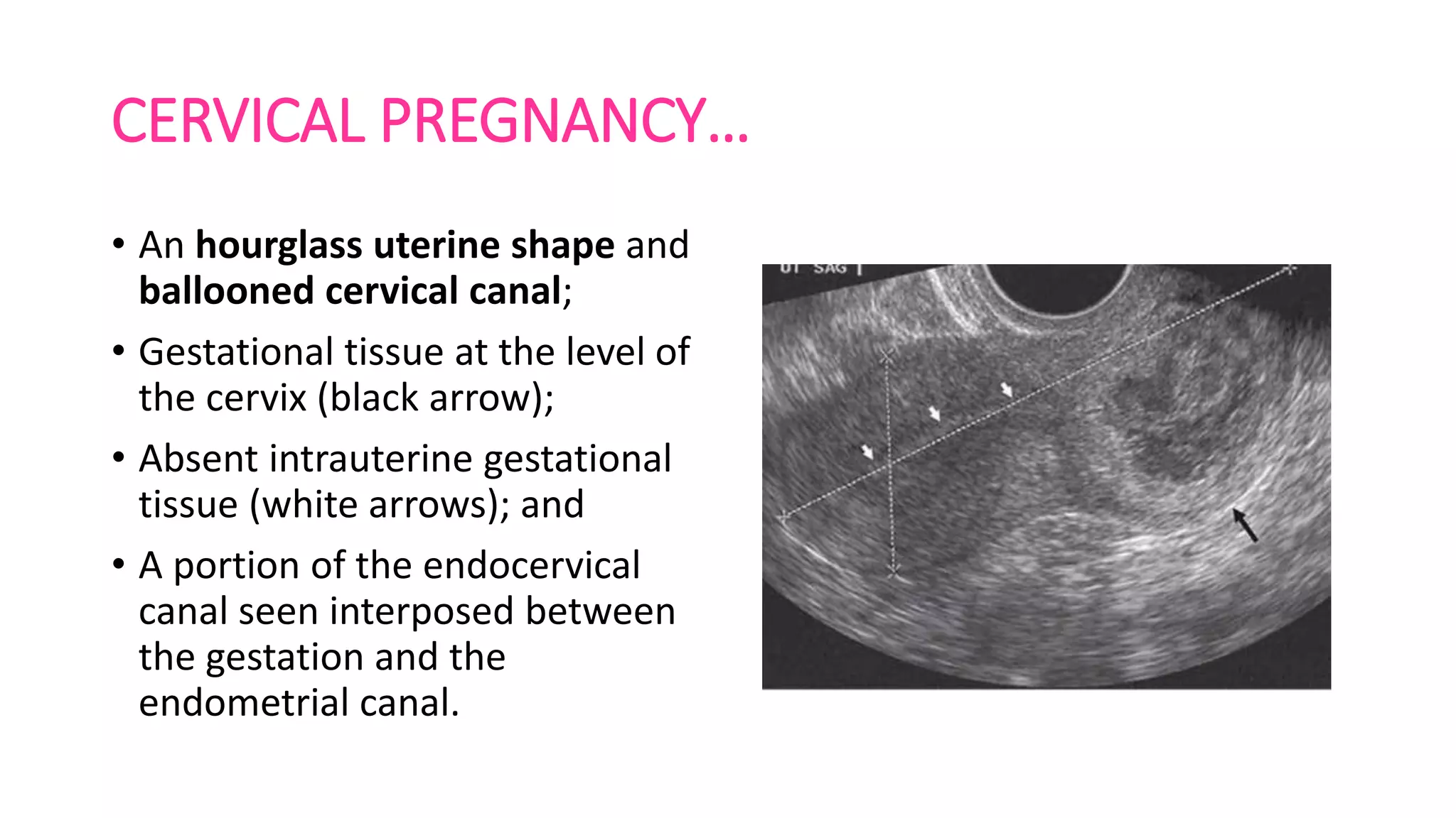 Ultrasound and usg doppler in obstetrics | PPTX