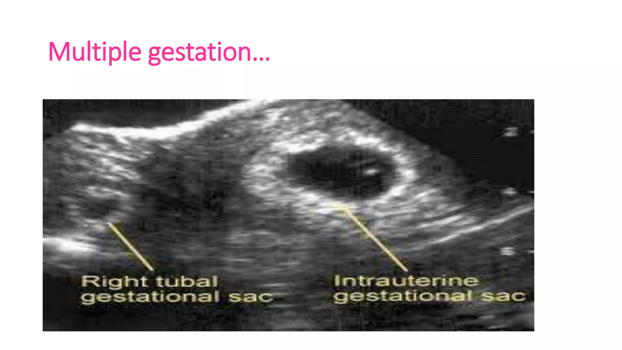 Ultrasound and usg doppler in obstetrics | PPTX