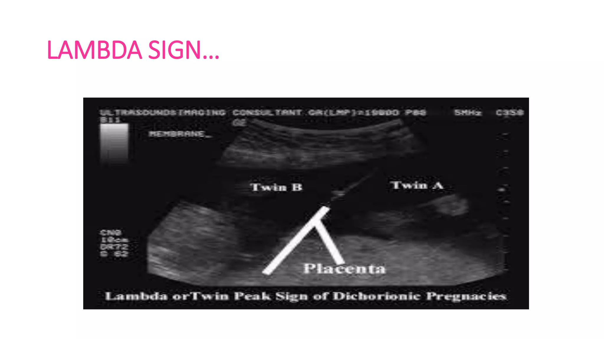 Ultrasound and usg doppler in obstetrics | PPTX