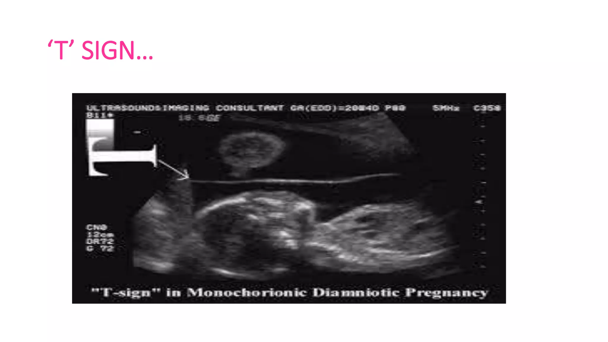 Ultrasound and usg doppler in obstetrics | PPTX
