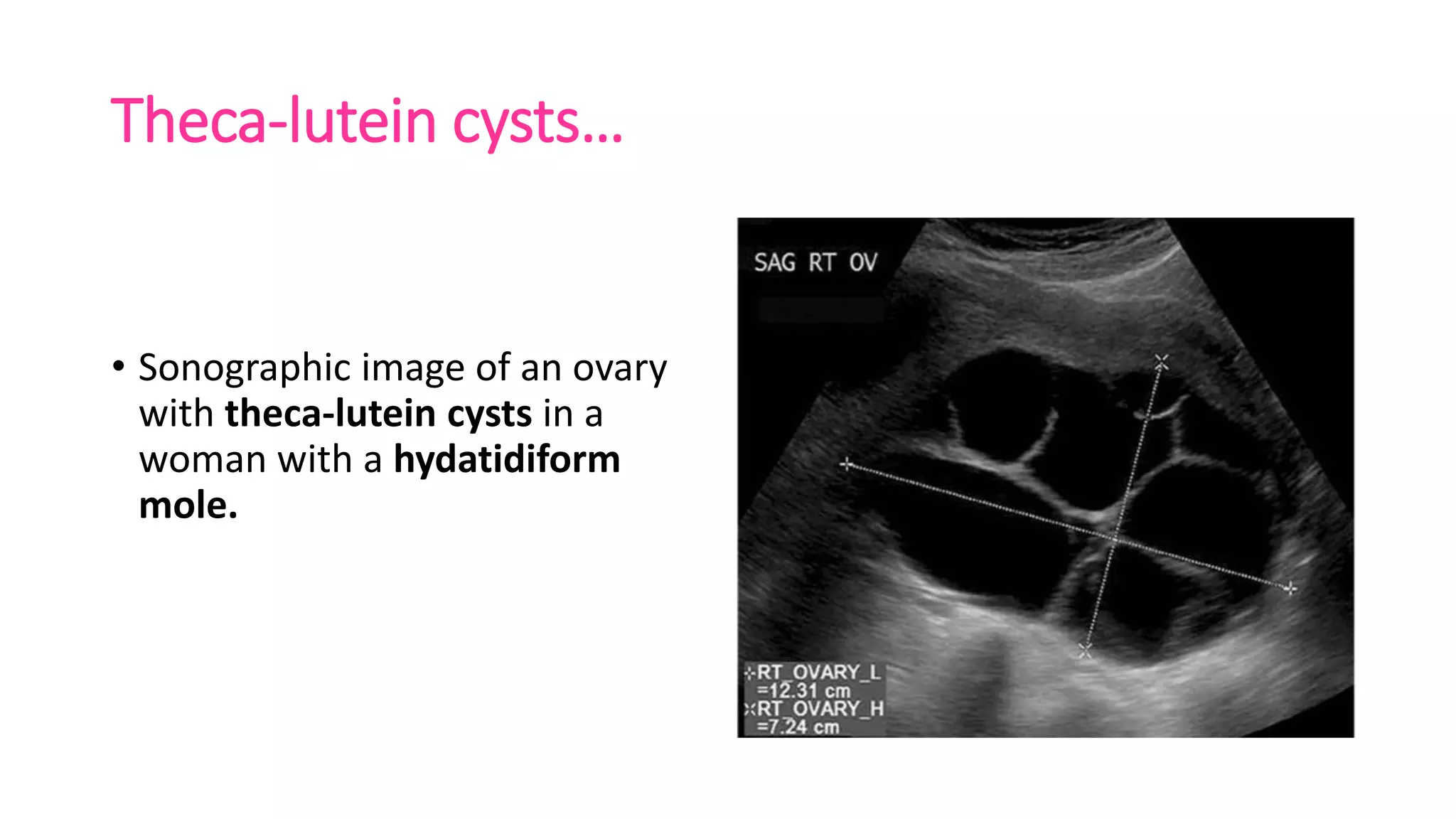 Ultrasound and usg doppler in obstetrics | PPTX