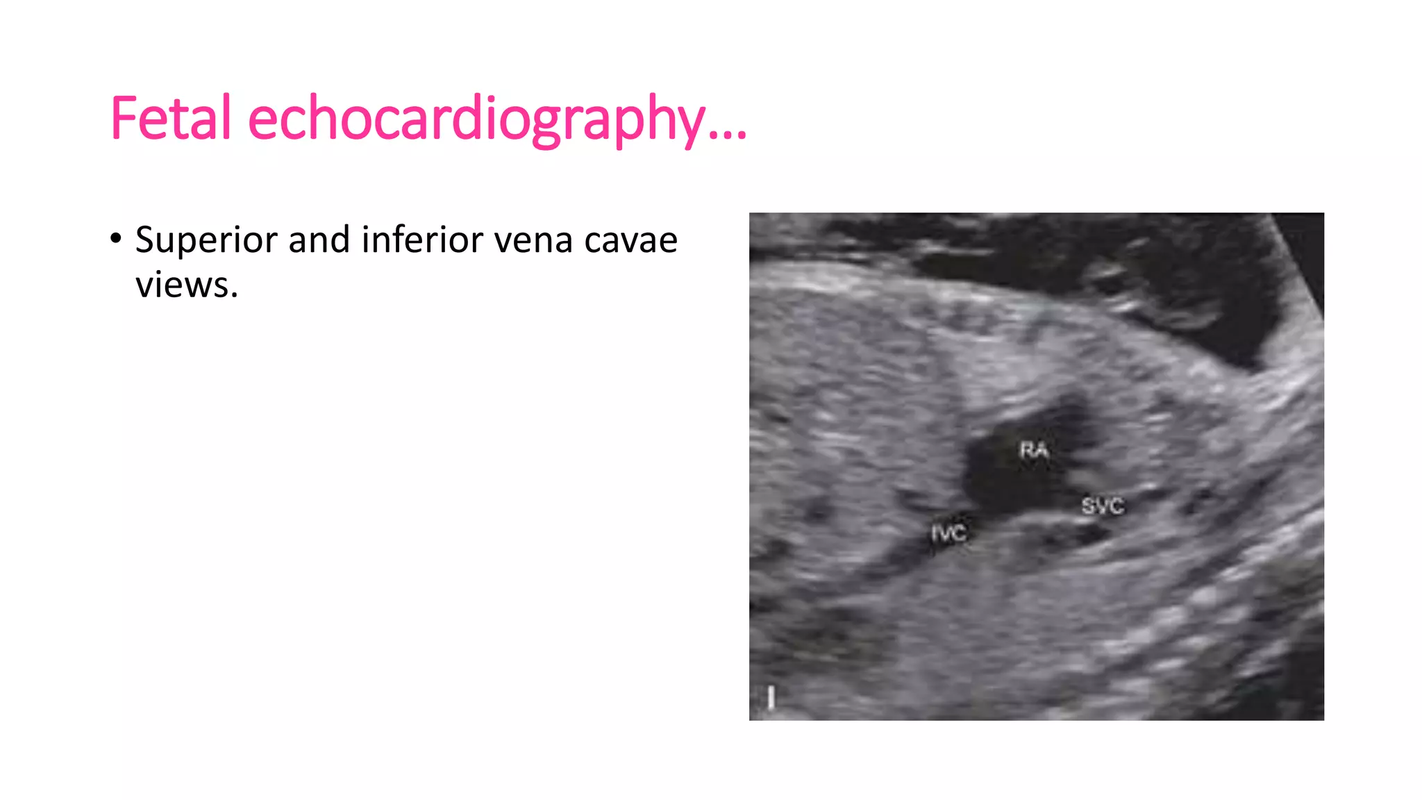 Ultrasound and usg doppler in obstetrics | PPTX