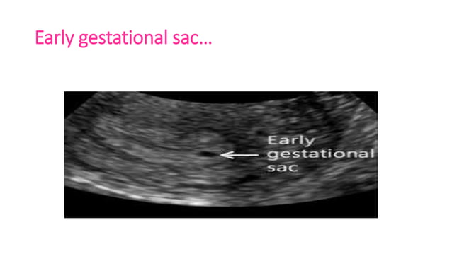 Ultrasound and usg doppler in obstetrics | PPTX | Pregnancy ...