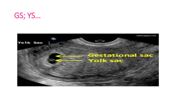 Ultrasound and usg doppler in obstetrics | PPTX | Pregnancy ...