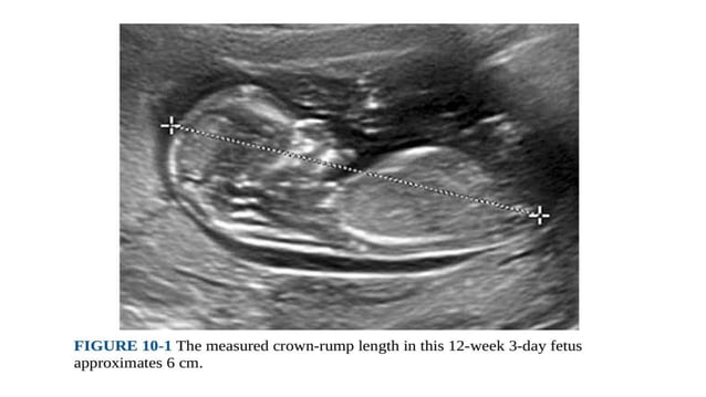 Ultrasound and usg doppler in obstetrics | PPTX | Pregnancy ...