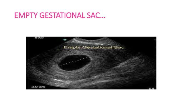 Ultrasound and usg doppler in obstetrics | PPTX | Pregnancy ...