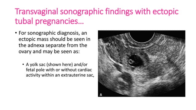 Ultrasound and usg doppler in obstetrics | PPTX | Pregnancy ...