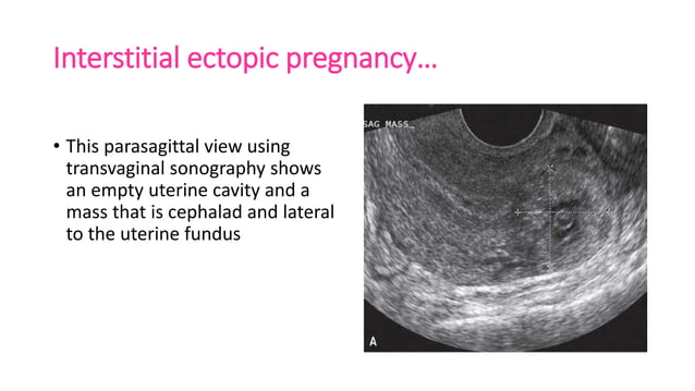 Ultrasound and usg doppler in obstetrics | PPTX | Pregnancy ...