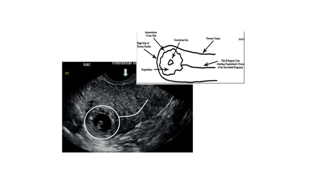 Ultrasound and usg doppler in obstetrics | PPTX | Pregnancy ...