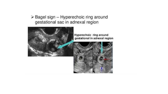 Ultrasound and usg doppler in obstetrics | PPTX | Pregnancy ...
