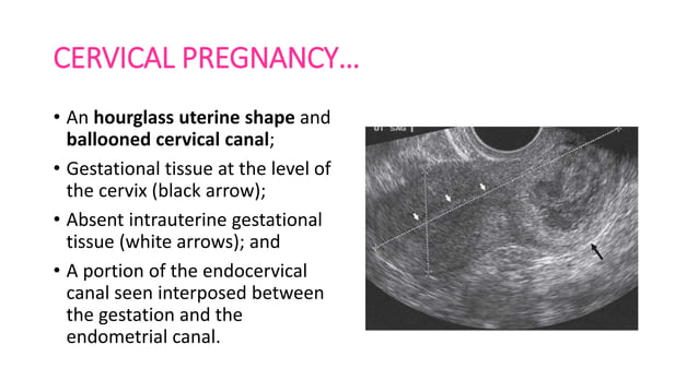 Ultrasound and usg doppler in obstetrics | PPT