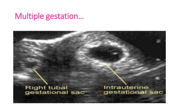 Ultrasound and usg doppler in obstetrics | PPTX | Pregnancy ...