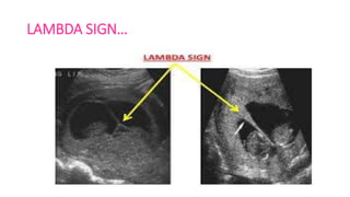 Ultrasound and usg doppler in obstetrics | PPTX