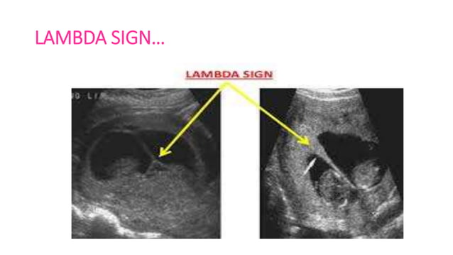 Ultrasound and usg doppler in obstetrics | PPTX | Pregnancy ...