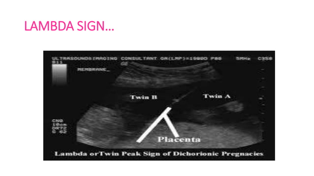 Ultrasound and usg doppler in obstetrics | PPTX | Pregnancy ...