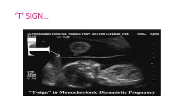 Ultrasound and usg doppler in obstetrics | PPTX | Pregnancy ...