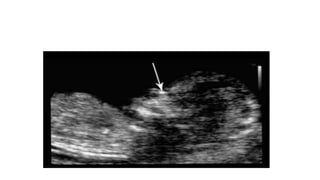Ultrasound and usg doppler in obstetrics | PPTX