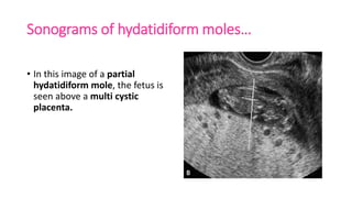 Ultrasound and usg doppler in obstetrics | PPTX