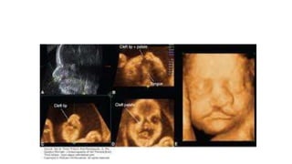 Ultrasound and usg doppler in obstetrics | PPTX