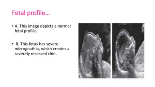 Ultrasound and usg doppler in obstetrics | PPTX