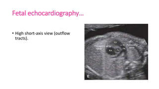 Ultrasound and usg doppler in obstetrics | PPTX