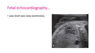 Ultrasound and usg doppler in obstetrics | PPTX