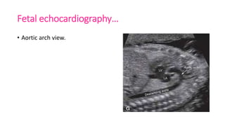 Ultrasound and usg doppler in obstetrics | PPTX