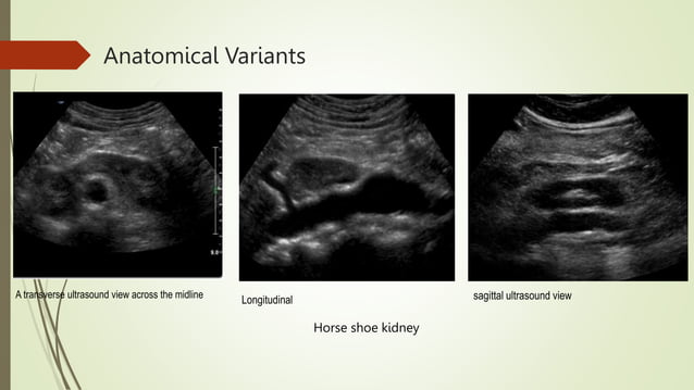 USG - Kidney.pptx | Medical Tests | Medical Health