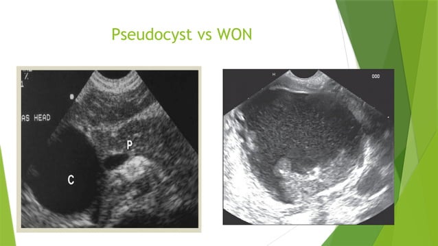 USG Acute abdomen radiology imaging .pptx