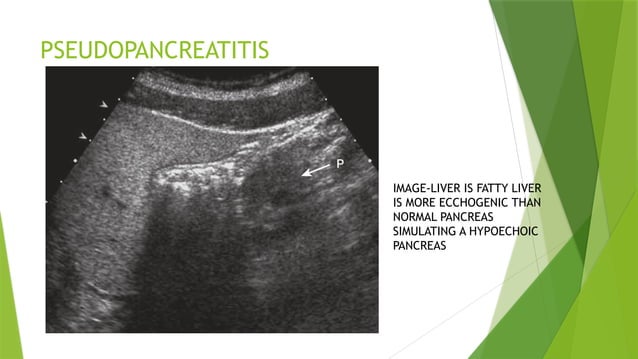 USG Acute abdomen radiology imaging .pptx