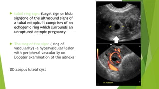 USG Acute abdomen radiology imaging .pptx