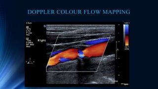 Usg and anaesthesia | PPTX