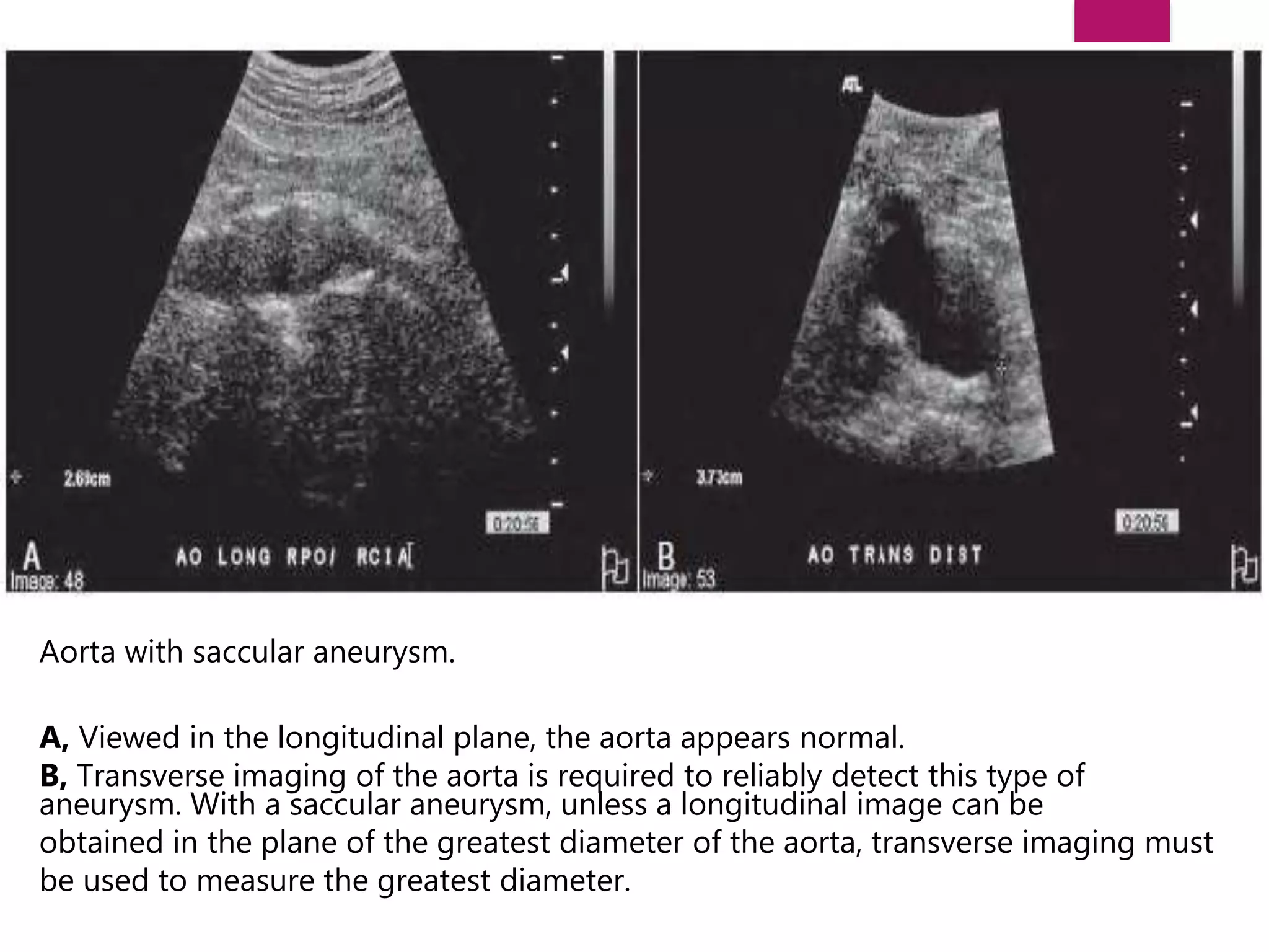USG of Aorta and Coeliac axis | PPTX