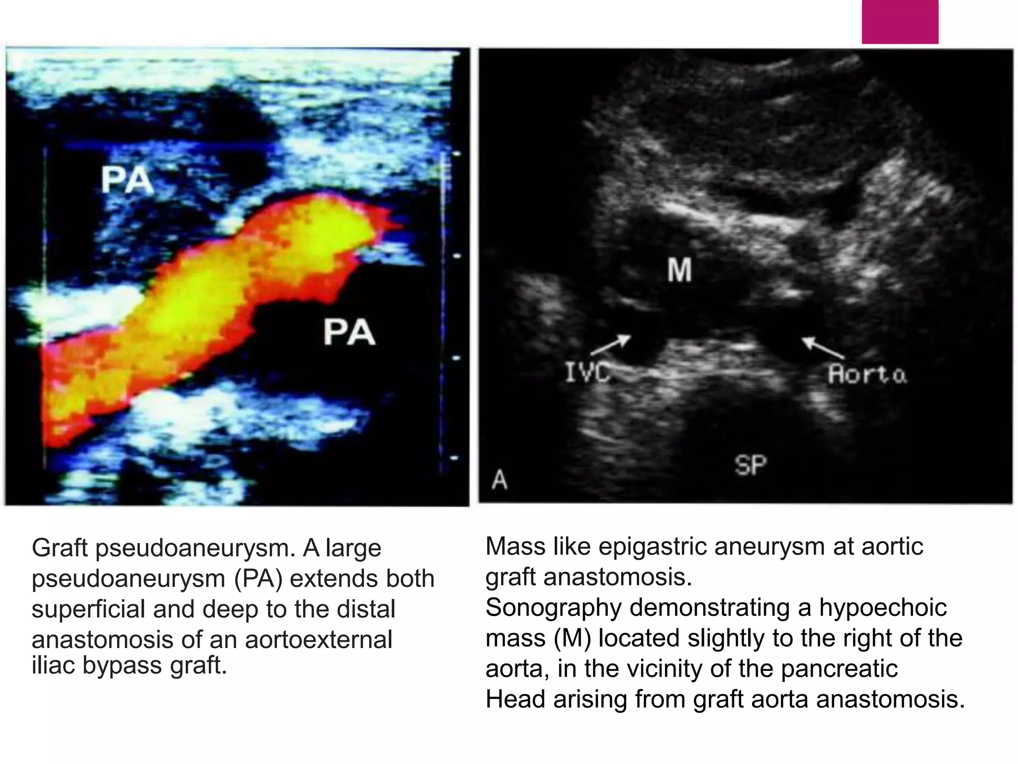 USG of Aorta and Coeliac axis | PPTX