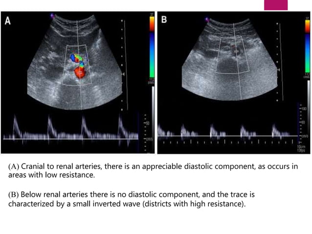 USG of Aorta and Coeliac axis | PPTX | Heart and Cardiovascular ...
