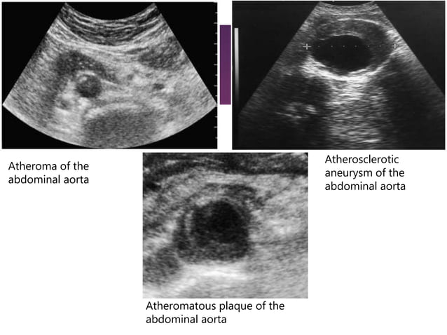 USG of Aorta and Coeliac axis | PPTX | Heart and Cardiovascular ...